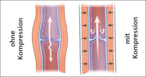 Welche Kompressionsstrümpfe nach Thrombose tragen?