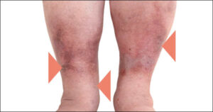 Welche Kompressionsstrümpfe nach Thrombose tragen?